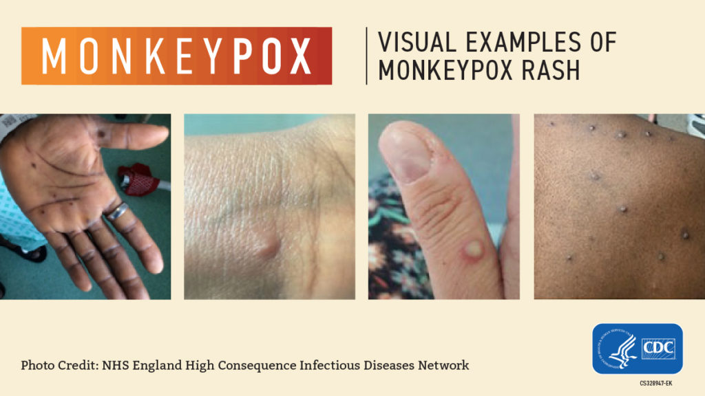 Mpox Monkeypox Virus Urban Indian Health Institute